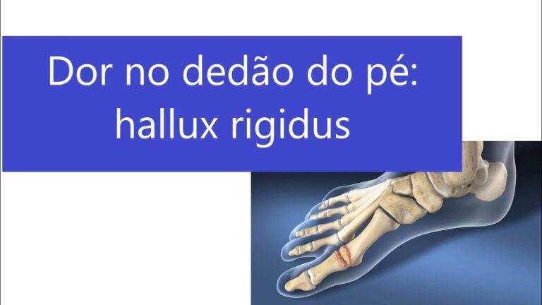 Hallux Rigidus: Possibilidades de Cura e Tratamento | Actualizado junio ...
